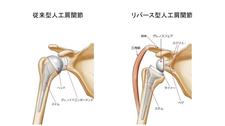 リバース型人工肩関節について | 副島整形外科